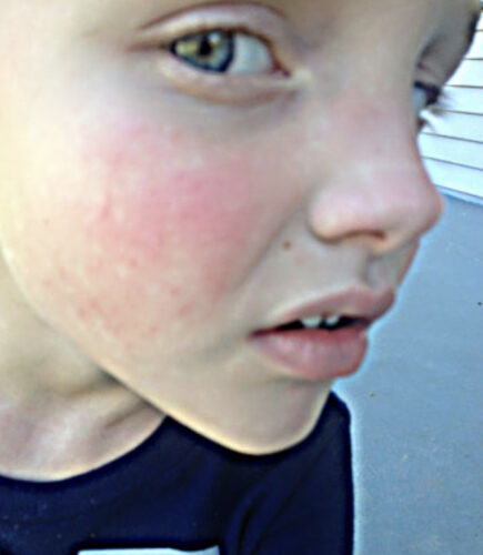 What is Juvenile Myositis? - Cure JM Foundation